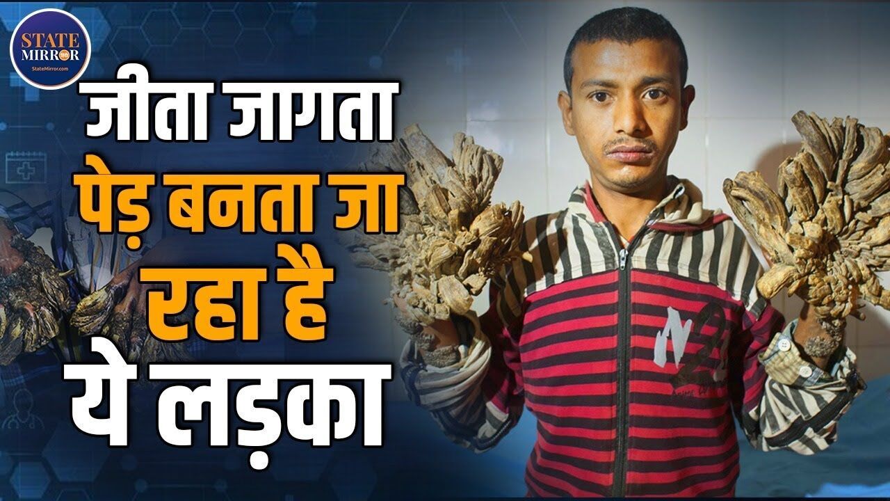 Tree Man Disease: इस शख्‍स को हुई दुर्लभ बीमारी, पेड़ जैसा बनता जा रहा ...